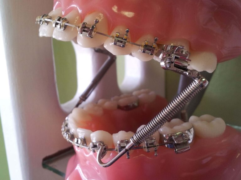 Springs in Braces - Amazing Smiles Orthodontics