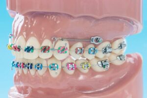 Springs in Braces - Amazing Smiles Orthodontics